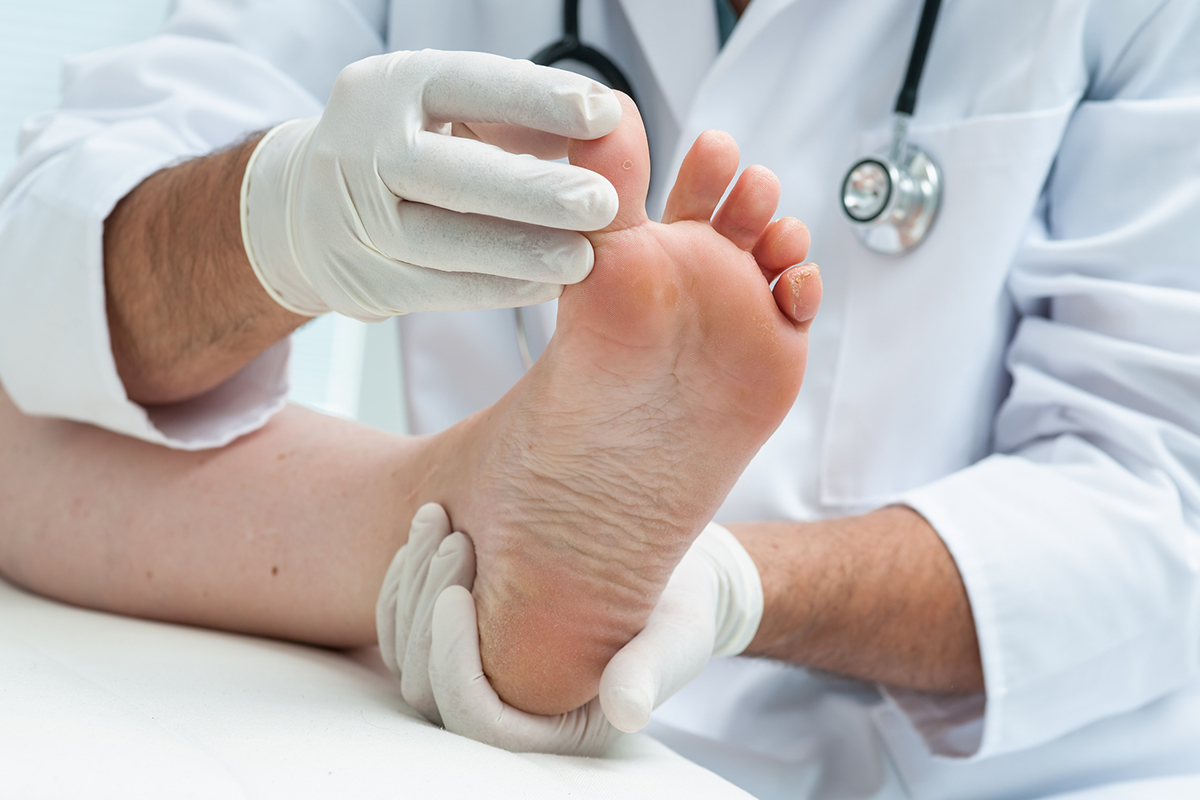 Verruche: come prevenirle e, se troppo tardi, come curarle - Humanitas ...