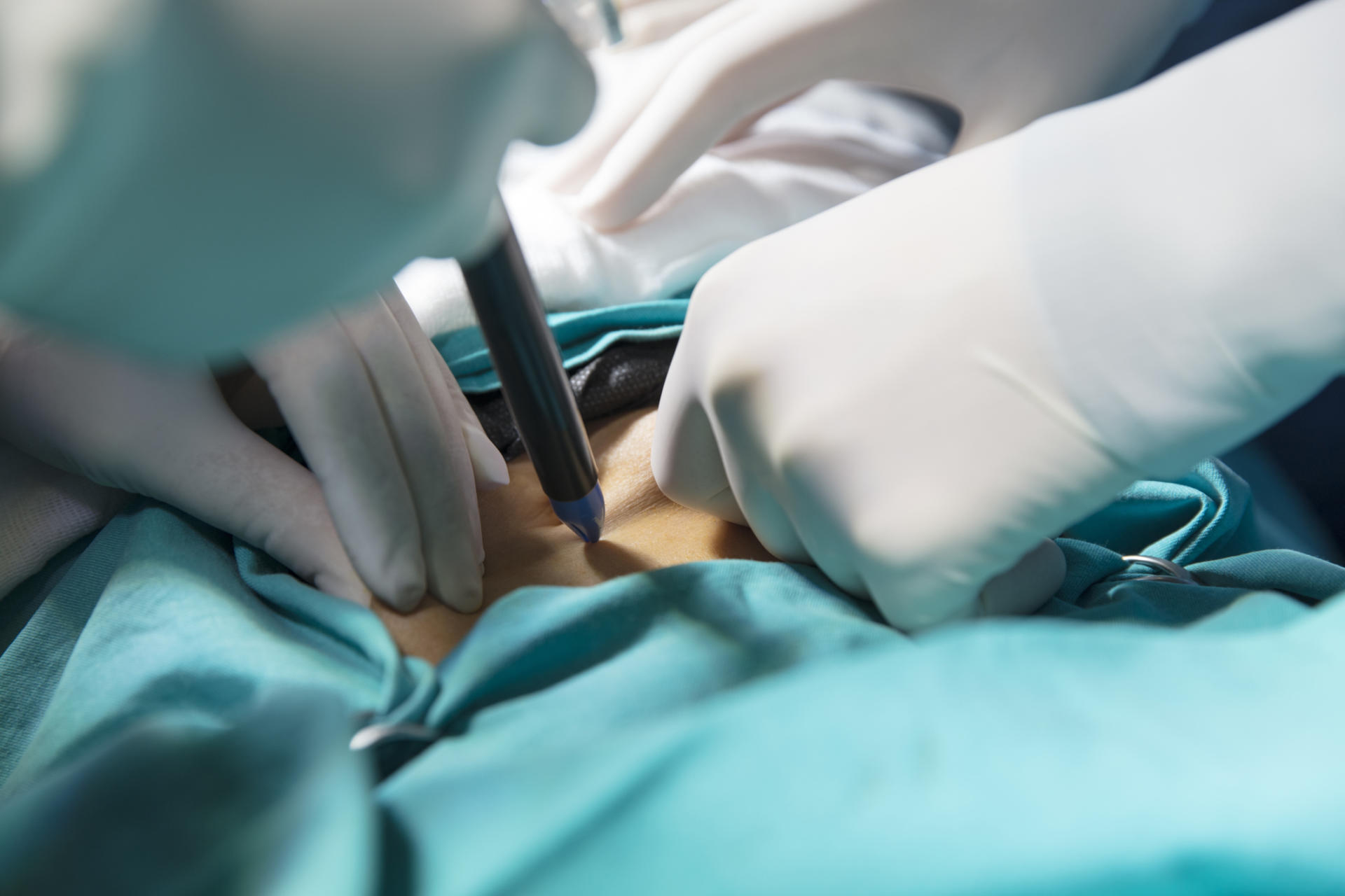 Che cos’è il laparocele e come si cura? - Humanitas Medical Care