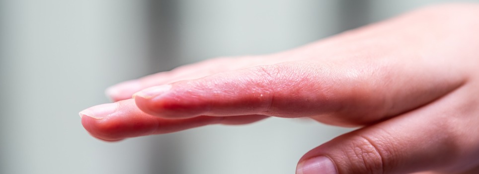 Disidrosi mani e piedi: cause e cura - Humanitas Medical Care