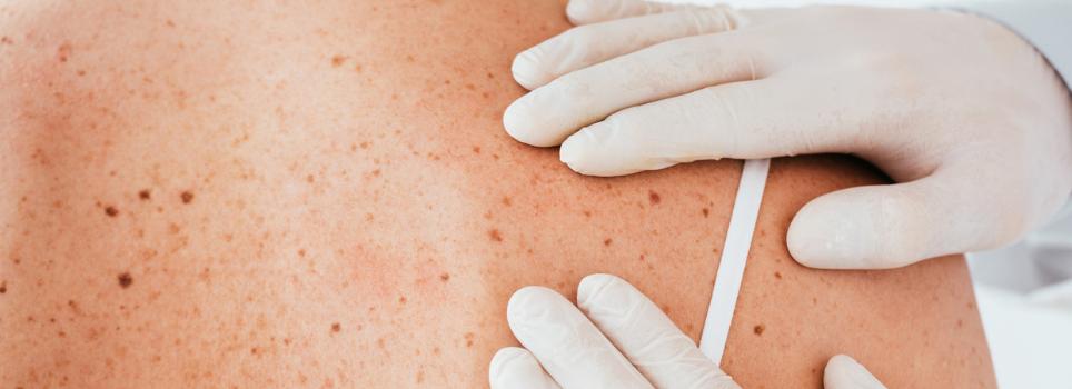 Mappatura nei: che cos'è e come si fa - Humanitas Medical Care